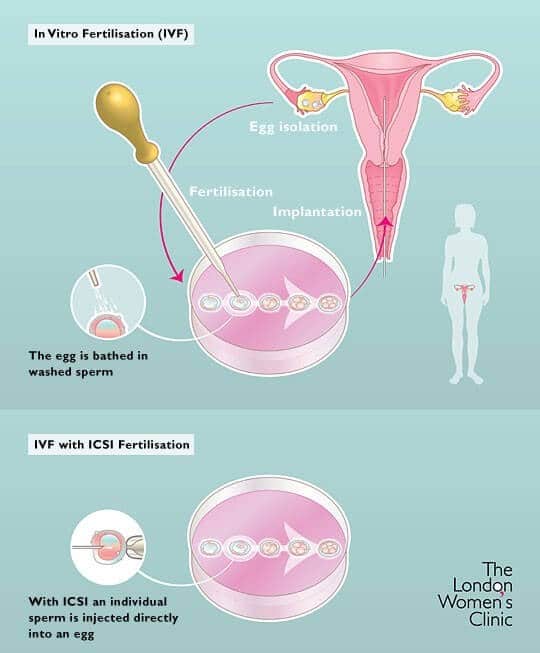5 Nadelen bij een IVF-behandeling + Beste Alternatief
